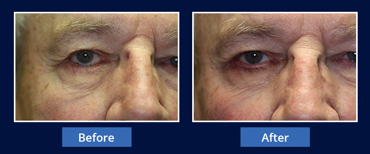 Entropion Repair Arlington & Fairfax, VA